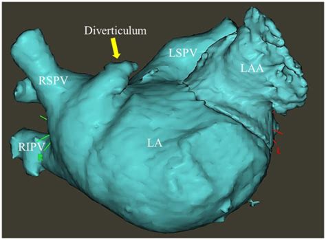 Epicardial Macroreentrant Atrial Tachycardia Involving A Large Left