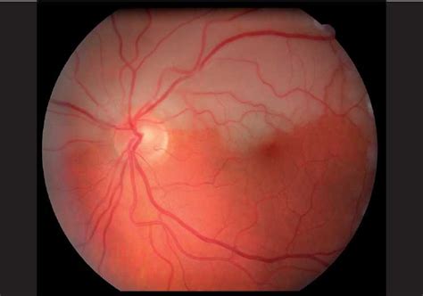 Dynamic Focal Retinal Arteriolar Vasospasm In Migraine Pmc