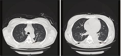 Chest Ct On Day 8 Bilateral Pleural Effusion And Local Atelectasis