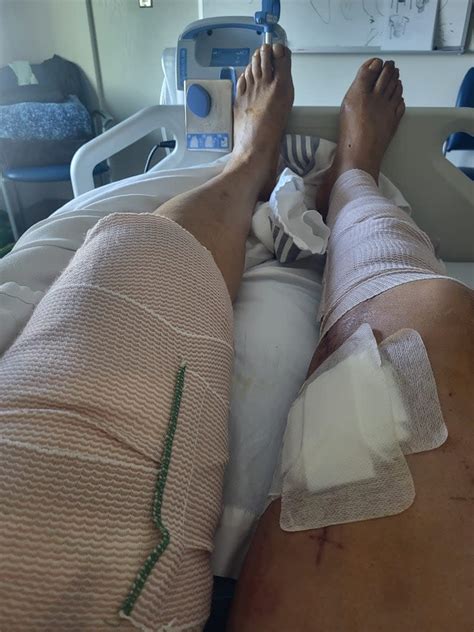 Potentially Deadly Strep Infections On The Rise In Nwt Chief Public