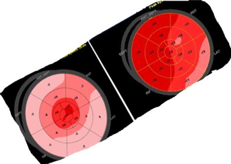 Pericarditis And Constrictive Pericarditis Flashcards Quizlet