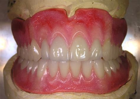 Festooning Dentures Pictures Flashcards Quizlet
