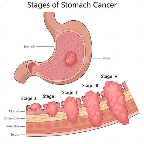 Stages Of Stomach Cancer Diagram Medical Science Stock Illustration