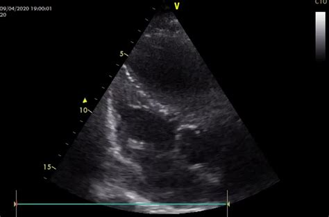 Dr Med Muhamet Sinani On Linkedin 55 Y Old Female On Chemotherapy Is