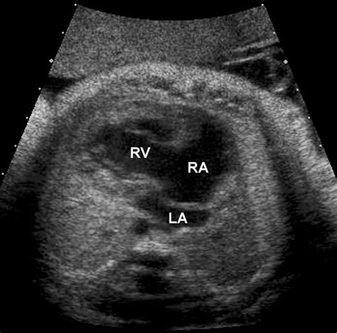 Hypo Plastic Left Heart Syndrome Medical Ultrasound Ultrasound