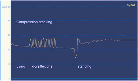 Pressure Under A Compression Stocking Pressure Range 20 30 Mmhg