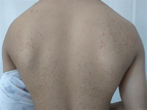 马拉色菌毛囊炎一例 医联