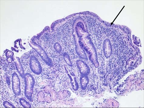 Photomicrograph Of Duodenal Mucosa The Duodenal Biopsy Demonstrates