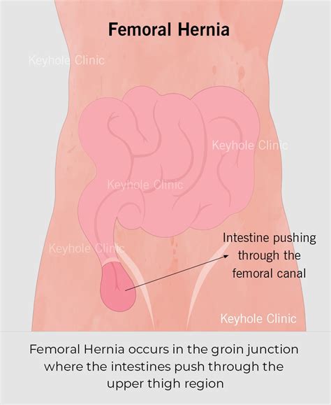 Groin Area Hernia