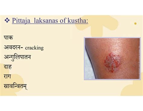 Kustha Ppt Pdf Kustha Definition Classification And Modern Probable Correlation Lakshanas Of