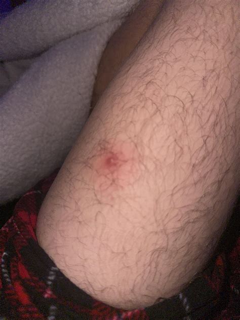 Is This A Tic Bite R Forestry