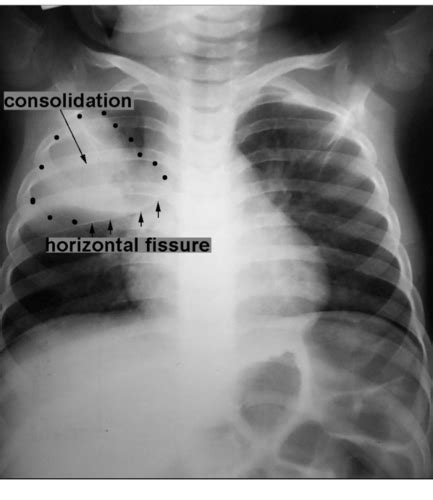 L4 Peds Pulm Flashcards Quizlet