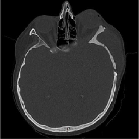 Virtual Step Stealth Neuronavigation Guided Simulated Craniotomy