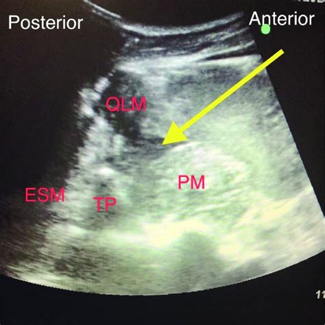 Bromage Scale Score Criteria Download Table