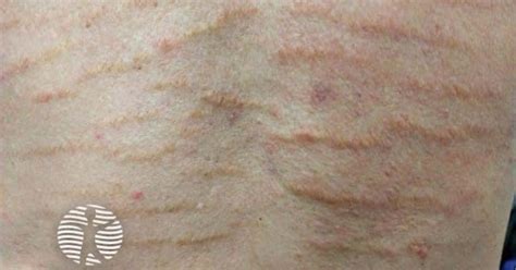 Linear Focal Elastosis Image