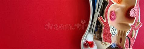 Colon Polyp Removal With Electrical Loop During Colonoscopy Stock Image