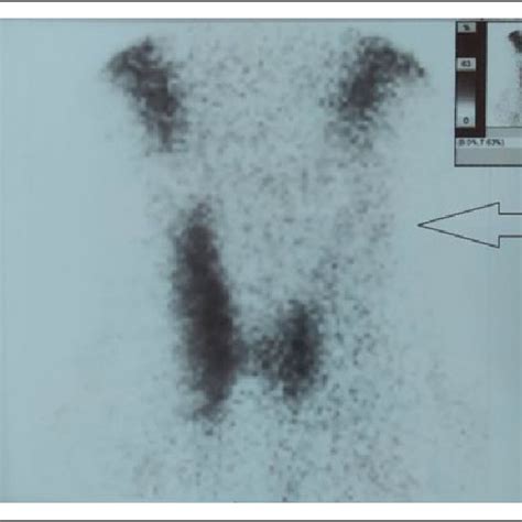In Thyroid Scintigraphy There Was No Uptake In The Left Thyroid Lobe Download Scientific