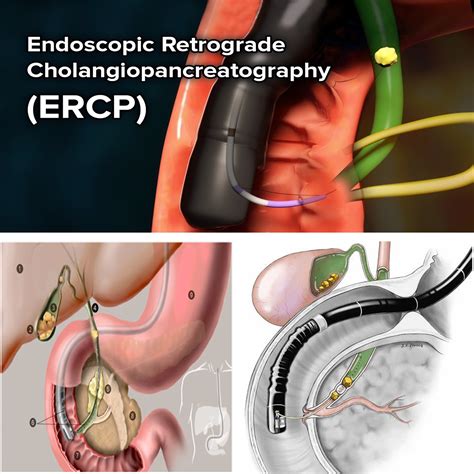 Ercp Stent Procedure