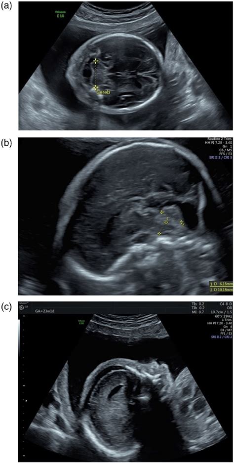 A Axial Us Image Of A Hypoplastic Cerebellum With A Transcerebellar Download Scientific