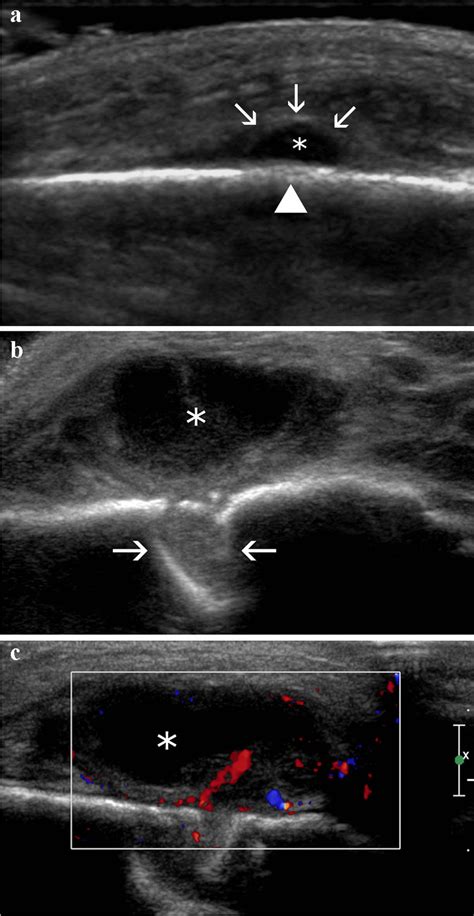Us Findings In Mastoiditis A Transverse Oblique View Of The Download Scientific Diagram