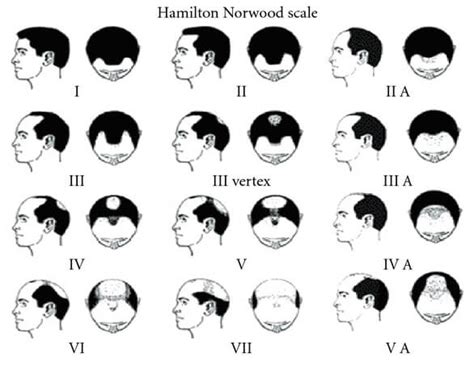 A Complete Guide To The Norwood Scale With 7 Real Examples