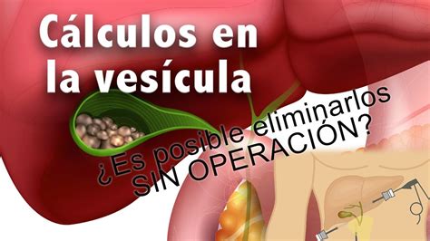 CÁlculos En La VesÍcula ¿es Posible Eliminar Sin 0peraciÓn Youtube