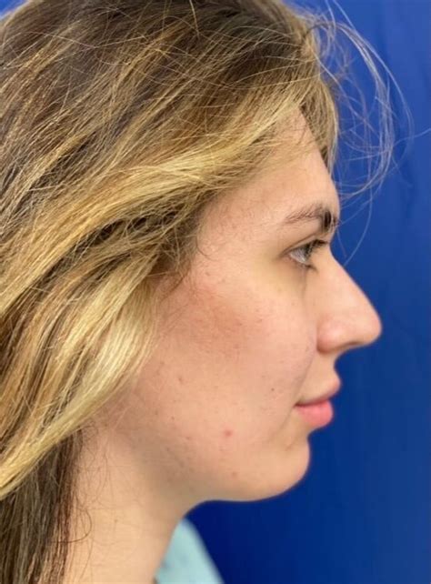 Before And After Forehead Brow Bone Reduction Beverly Hills And Nyc
