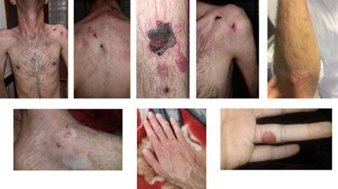 Expanding The Clinical Phenotype Of Plectin Related Plectinopathies Pmc