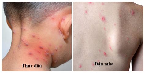 Smallpox Vaccine Stages