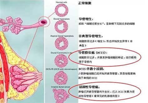 关于乳腺癌，每一个女性都要知道的事情