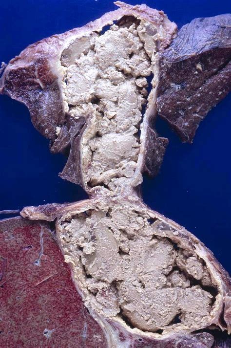 Echinococcus Hydatid Cyst Involving Liver And Lung A Photo On