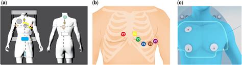 Different Impedance Tracking Patching A Ensite Location Patch Download Scientific Diagram