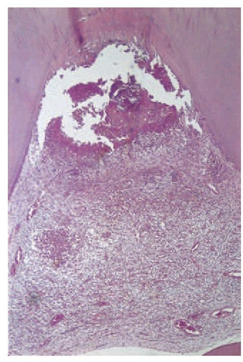 Acute Caries And Pulpitis Medizzy Acute Caries And Pulpitis Medizzy