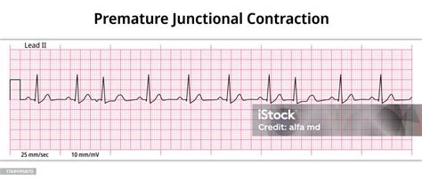 Ekg Kontraksi Junctional Prematur 8 Kertas Ekg Kedua Ilustrasi Stok