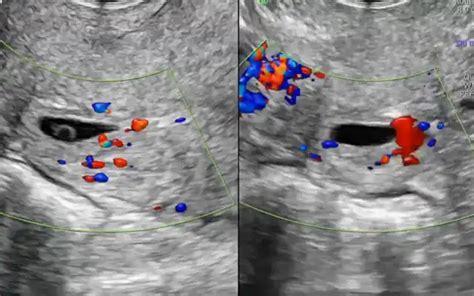 Histerectomía Total Laparoscópica Y Salpingectomía Bilateral Isge