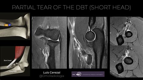 Distal Bicep Tendon Mri Imaging The Biceps Tendon At Both The Shoulder