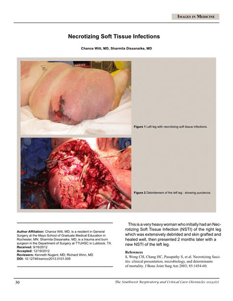 Pdf Necrotizing Soft Tissue Infection