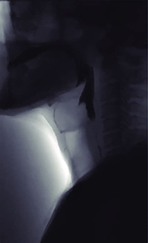 Barium Study 6 Months Post Intervention Download Scientific Diagram