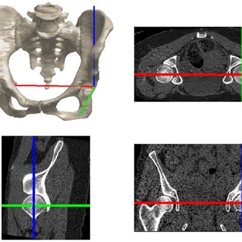 The Radiological Angles Of The Hip Include The Center Edge Ce Angle Download Scientific