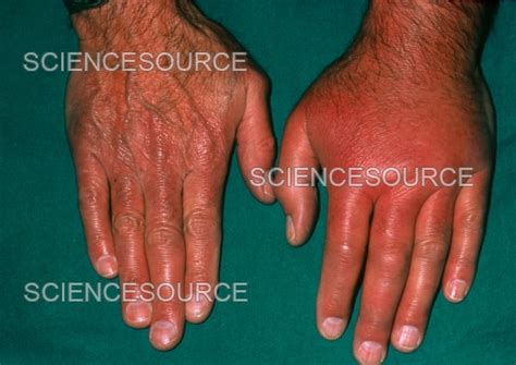 The Hand Of A Patient Affected By Gout Stock Image Science Source