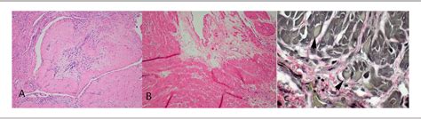 Figure 1 From Abnormal Uterine Involution May Lead To Atony And Postpartum Hemorrhage A