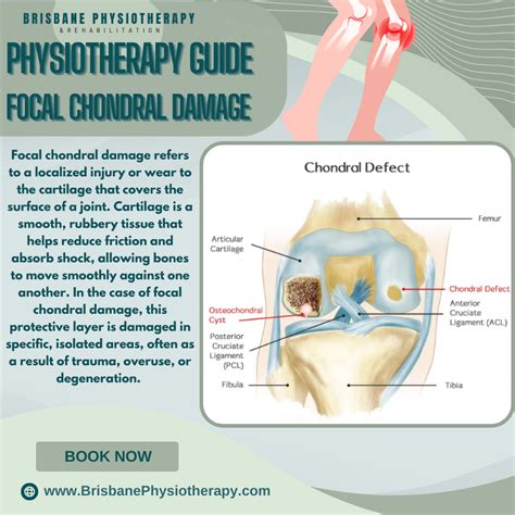 Physiotherapy Guide Focal Chondral Damage Brisbane Physiotherapy