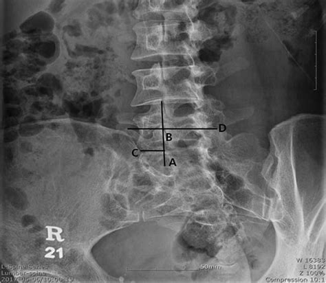Sacral Foramina Xray