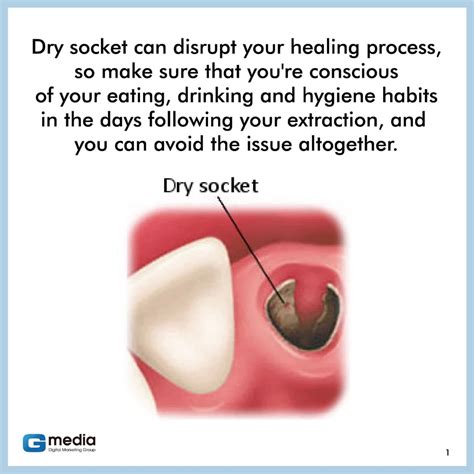 Ace Tips About How To Cure Dry Socket Philosophypeter5