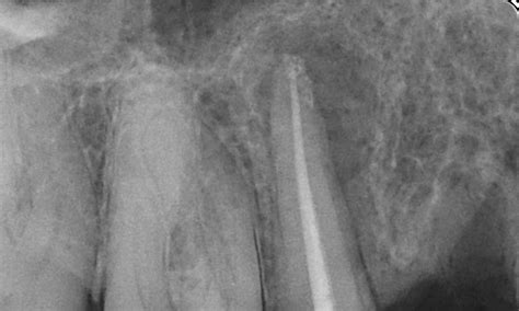 Emergency Root Canal Upper Premolar And Extraction Infected Retained Root Before And After Photos
