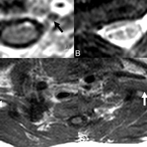 A An Elongated C7 Transverse Process On The Right Small Arrow And Download Scientific