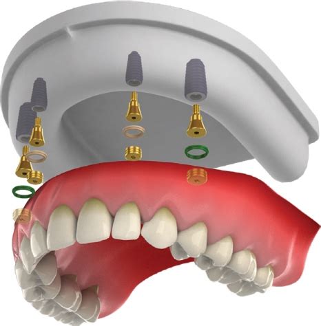 Overdenture System Megagen Implant