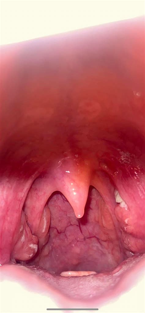 Are These Tonsil Stones Rtonsilstones