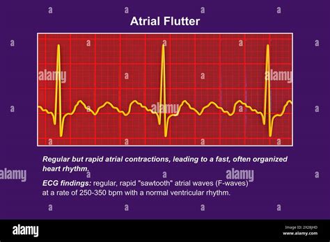 ECG In Atrial Flutter Illustration Stock Photo Alamy
