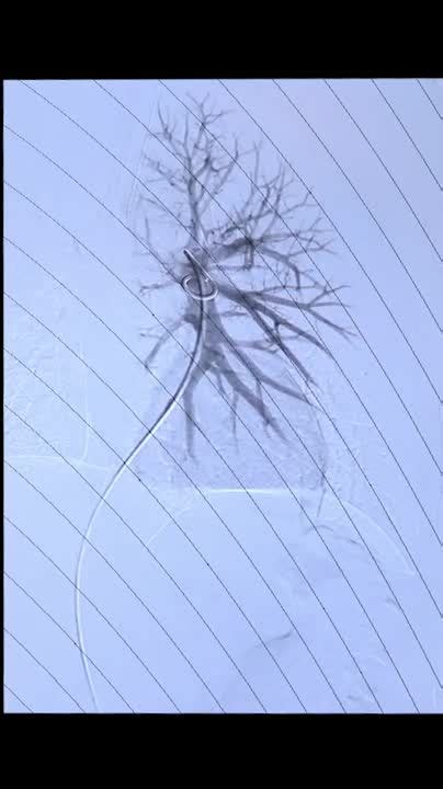 Pulmonary Avm Embolization By Dr Pollak Jomi Surgical Video Journal